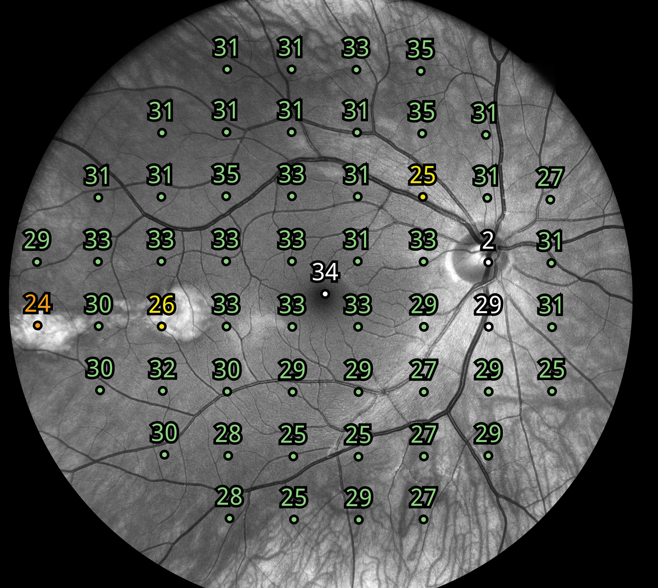 iCare COMPASS | Perímetro automatizado com rastreamento de retina ativo